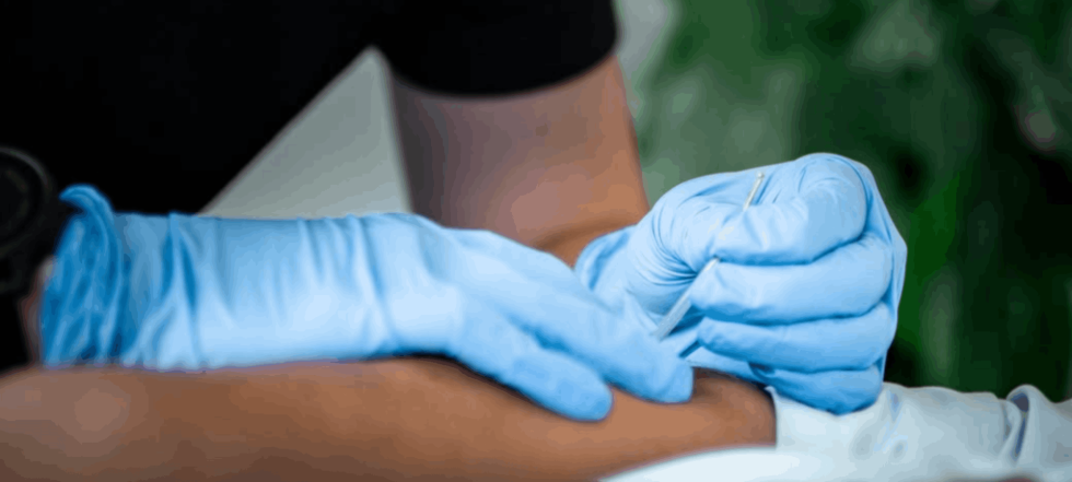 Dry Needling vs Acupuncture: What's the Difference? | South Island ...
