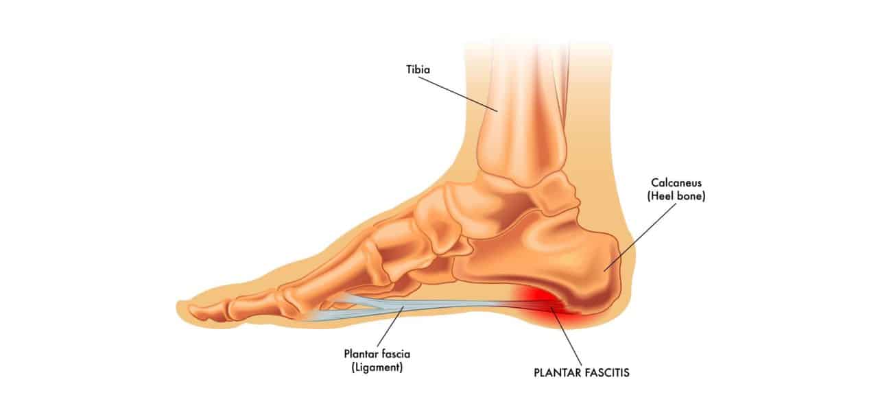 Examining Orthotics and Insoles for Plantar Fasciitis Pain