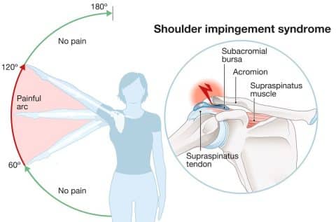 Shoulder Impingement Syndrome - What It Is And How To Fix It - South ...
